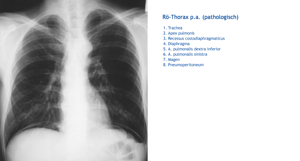 Thorax p.a., Pneumoperitoneum