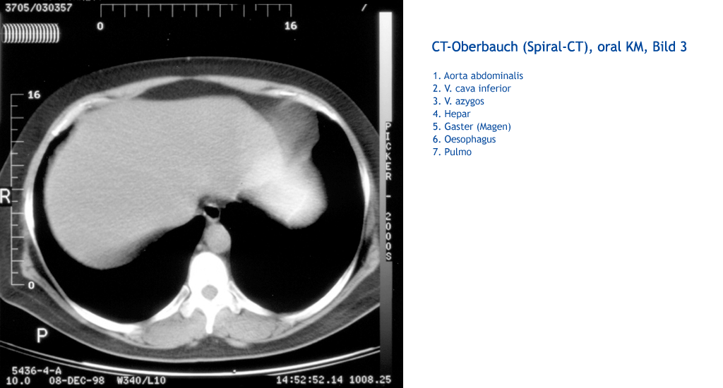CT Oberbauch oral KM, Bild 03