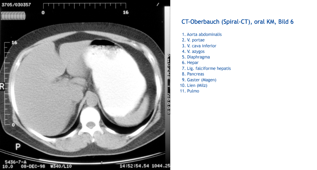 CT Oberbauch oral KM, Bild 06