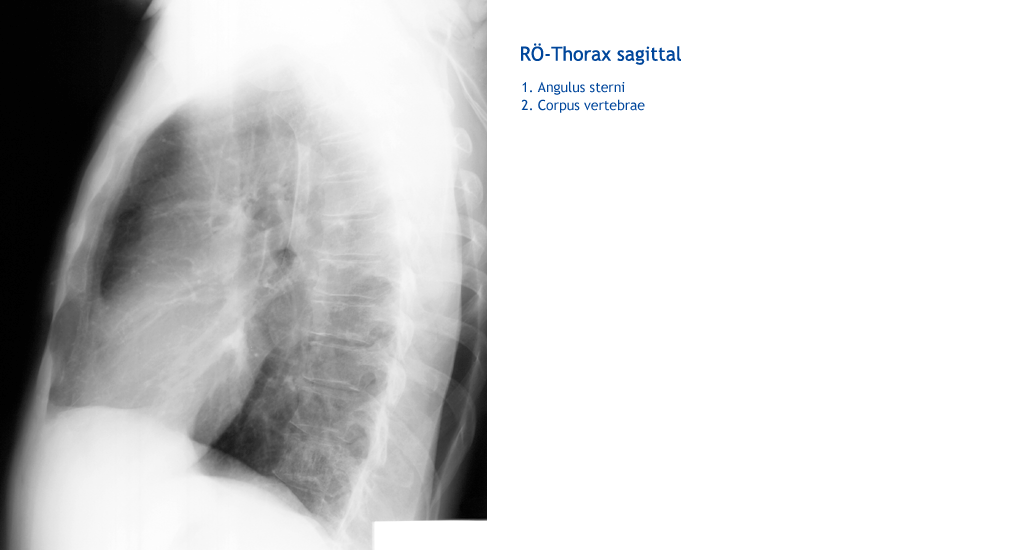 knöcherner Thorax sagittal