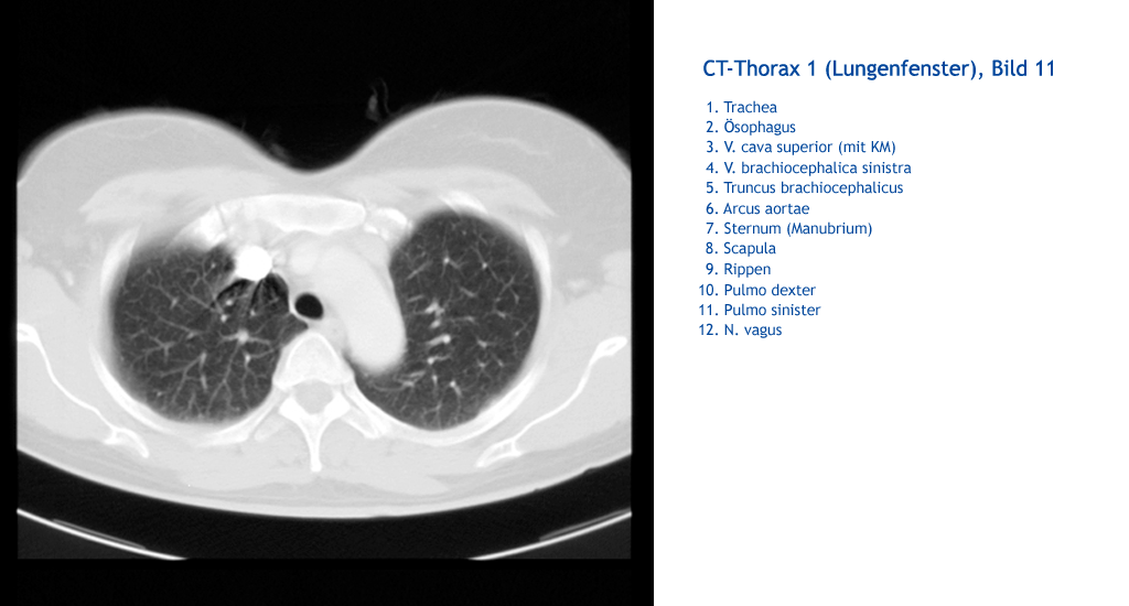 CT Thorax 1, Bild 11